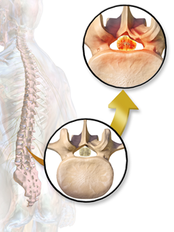 Thoracic Herniated Disc Surgery - Outcome, Prognosis and Recovery